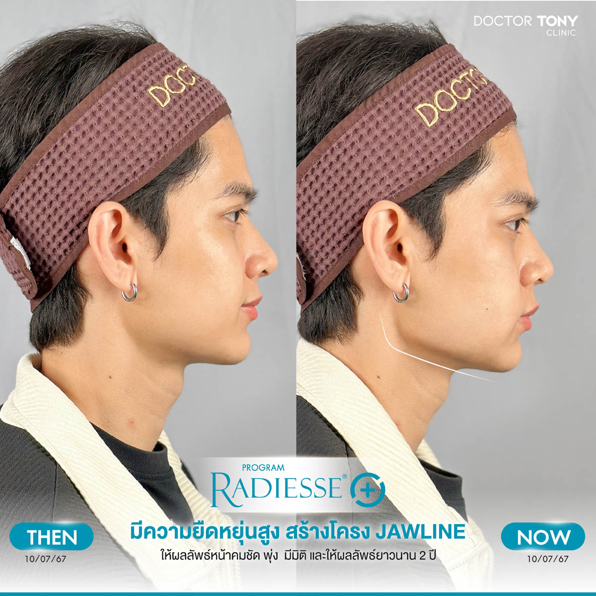 Radiesse plus program ยกกระชับ ปรับกรอบหน้า Doctor Tony Clinic