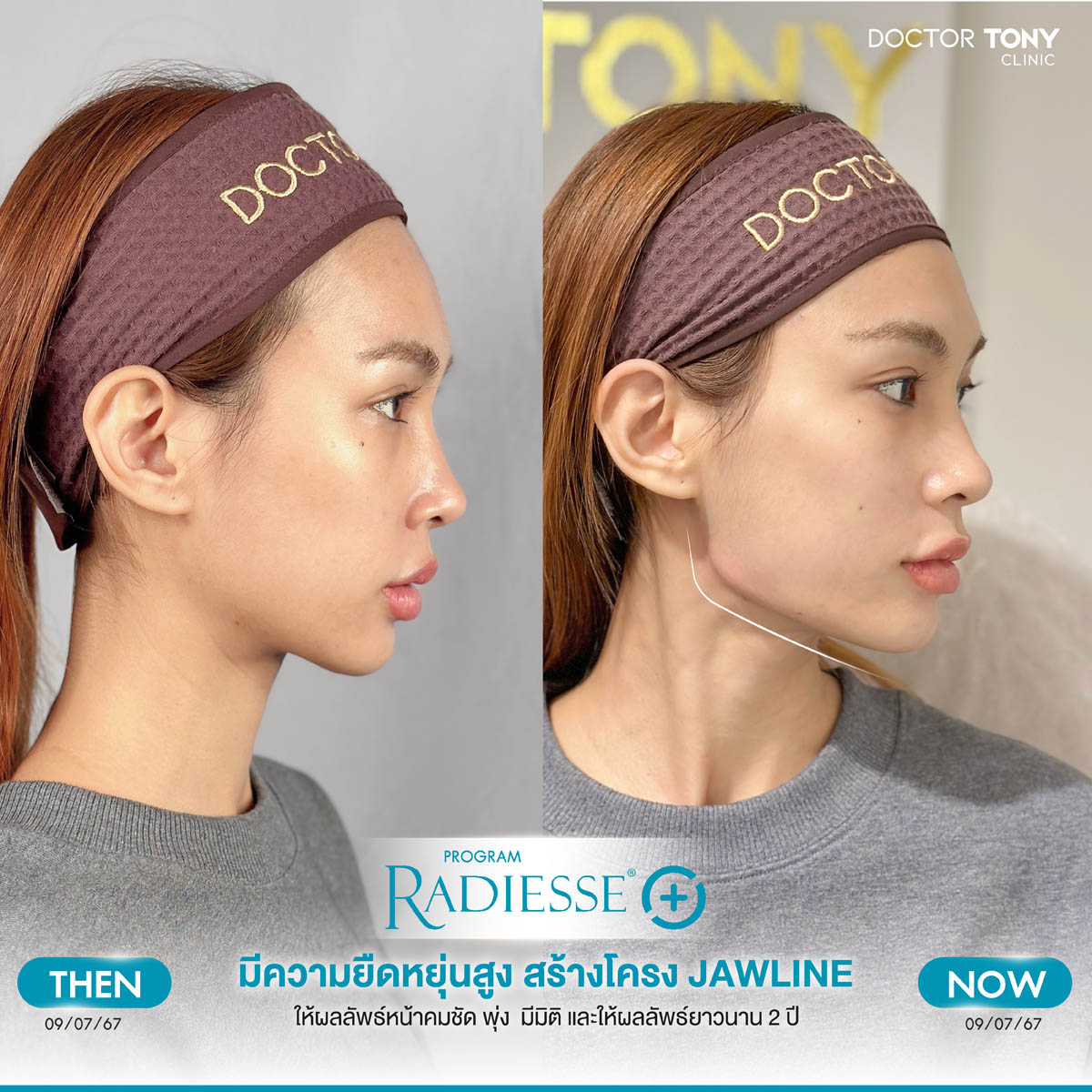 Radiesse plus program ยกกระชับ ปรับกรอบหน้า Doctor Tony Clinic