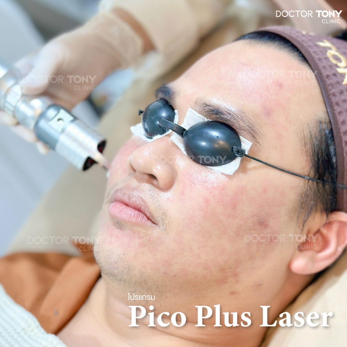 Pico Plus Laser รักษารอยดำ รอยแดง ให้ผิวหน้ากลับเรียบเนียน
