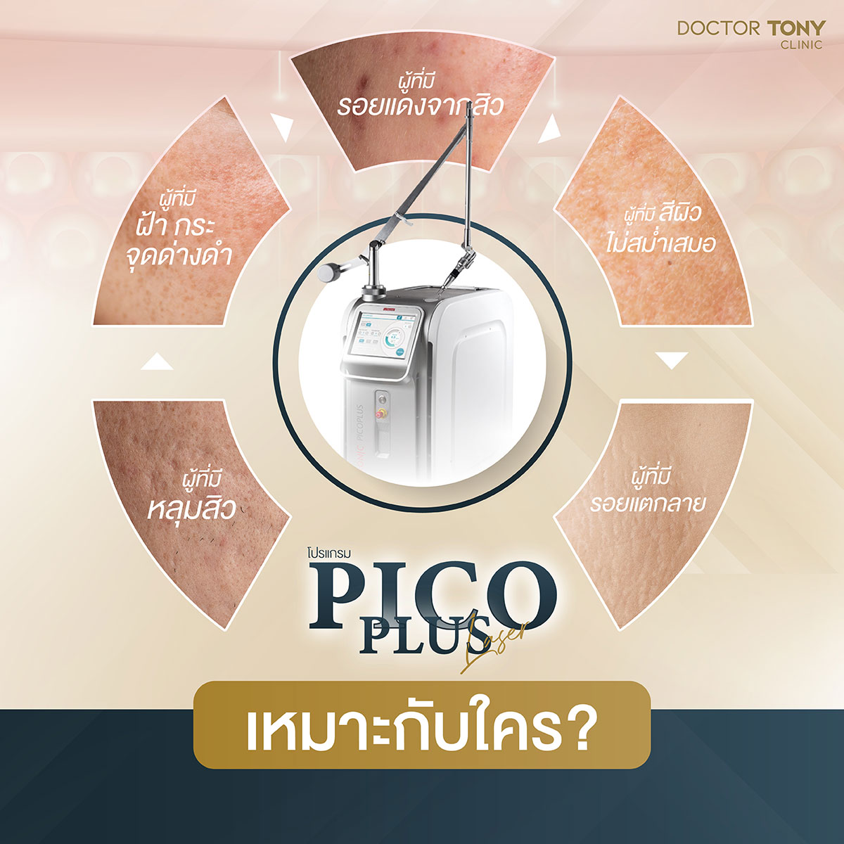 Pico Plus Laser รักษารอยดำ รอยแดง ให้ผิวหน้ากลับเรียบเนียน