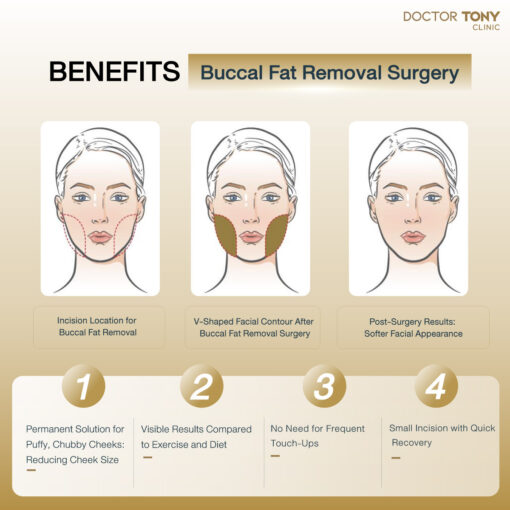 Buccal Fat Removal Surgery