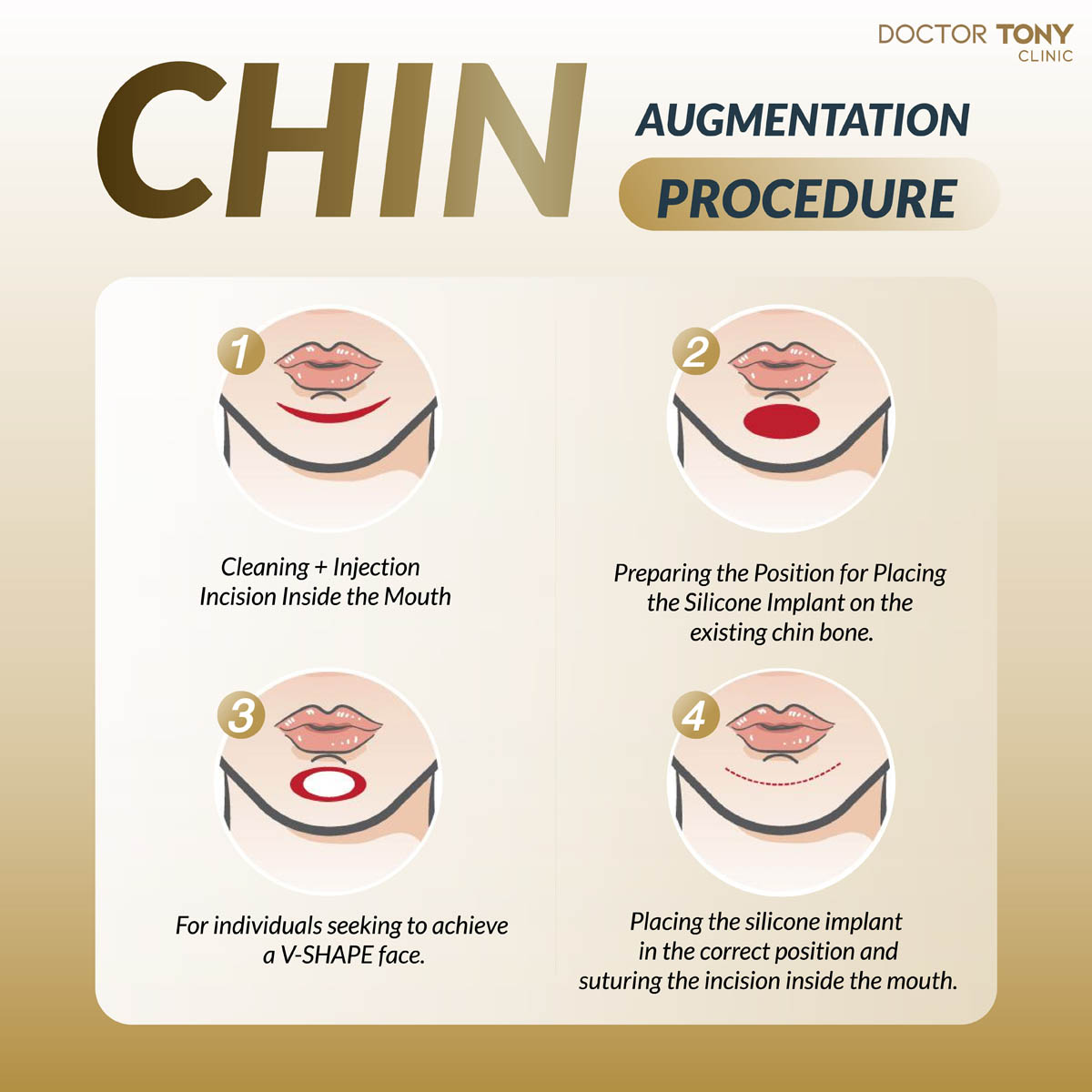 Chin Augmentation Surgery with Silicone - Doctor Tony Clinic