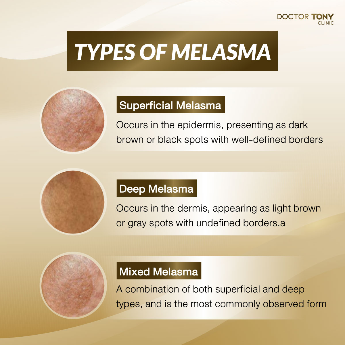 Melasma Dissolving Injection