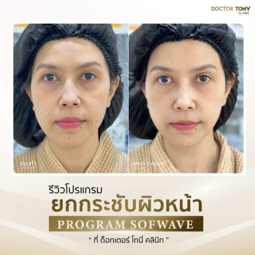 Sofwave ยกกระชับผิวลงลึกถึงชั้นหนังแท้