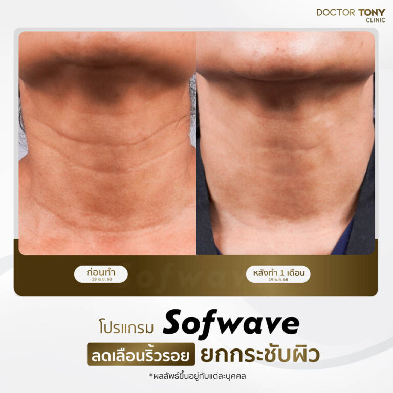 Sofwave ยกกระชับผิวลงลึกถึงชั้นหนังแท้