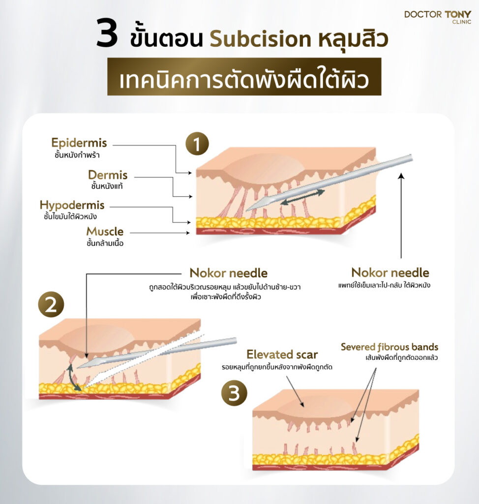 Subcision หลุมสิว คืออะไร? รักษาหลุมสิวได้จริงมั้ย? - Doctor Tony Clinic